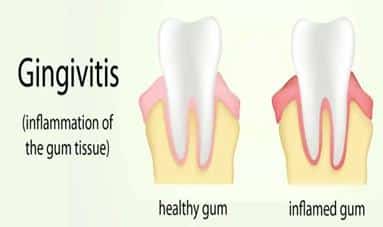 Gingivitis - 4 Best Ways to Prevent and Treat - Casa Dental